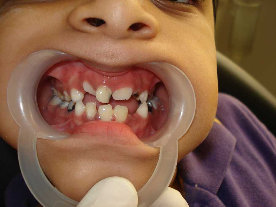 How To Prevent Dental Cavities In Children 